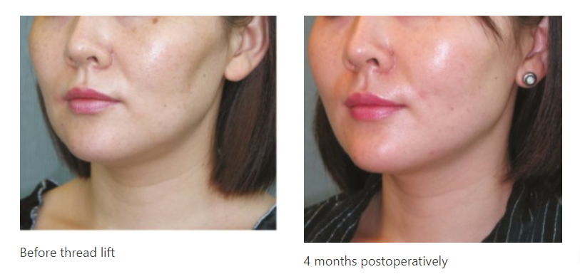9 Thread Lift Complications You Should Know About Before Getting It on ...