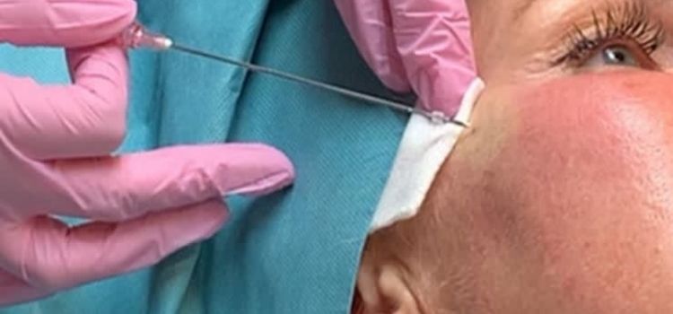 How to Deal With Lumps After Thread Lift - Yastrid Medical Aesthetic ...