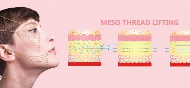 How Long Does a Thread Lift Last? - Yastrid Medical Aesthetic Supplier