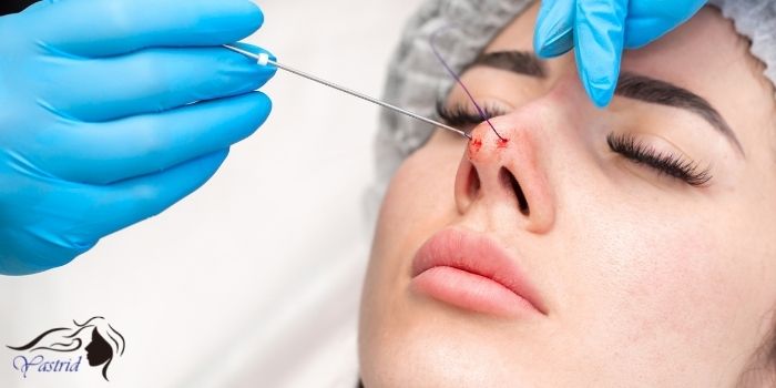 Types of Nose Threads - Yastrid Medical Aesthetic Supplier