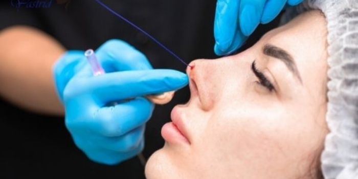 Reasons for a Nose Thread Lift Gone Wrong - Yastrid Medical Aesthetic ...