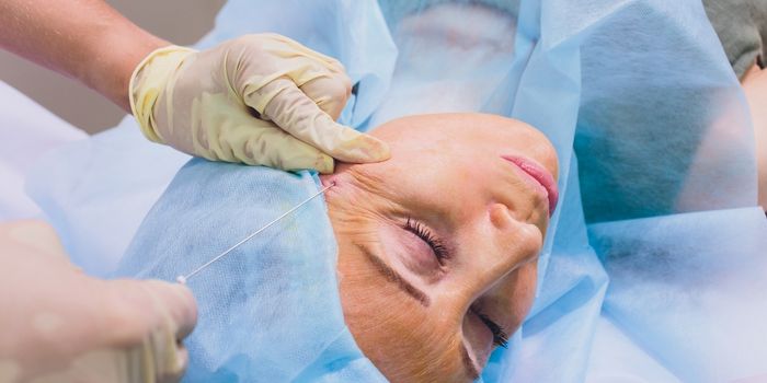 Are PDO Thread Lifts Worth It