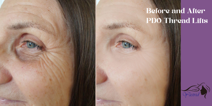 Before and After PDO Thread Lifts - Yastrid Aesthetics Medcine