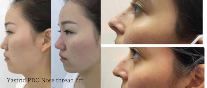 How Long Does Nose Thread Lift Last? Exploring the Duration of Results