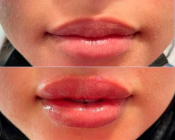 1ml vs 2ml Lip Filler, How to Choose The Right Fillers