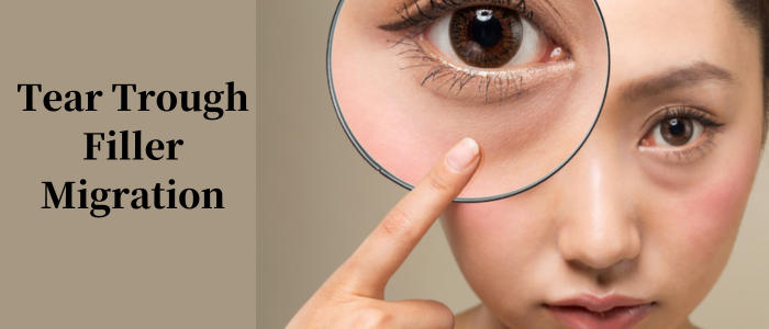 What Is Tear Trough Filler Migration? How to Solve?