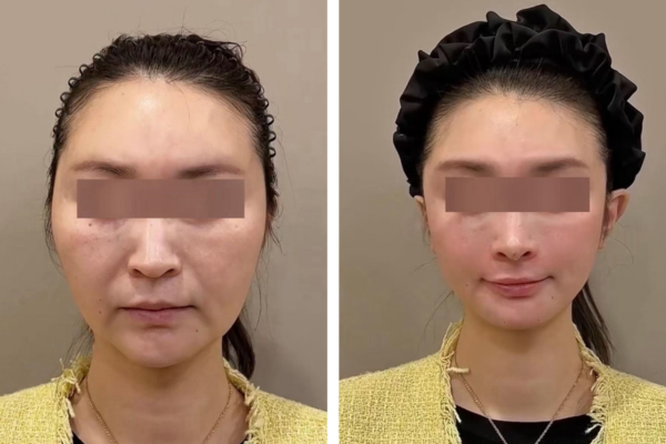 How to Achieve Softer Face Contour Without Surgery - Yastrid Medical ...