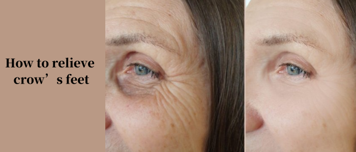 The 5 Most Effective Treatments for Crow's Feet - Yastrid Medical ...