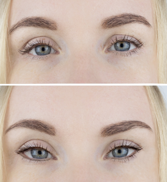 Fox Eye Threads | Creating A Refined Facial Appearance