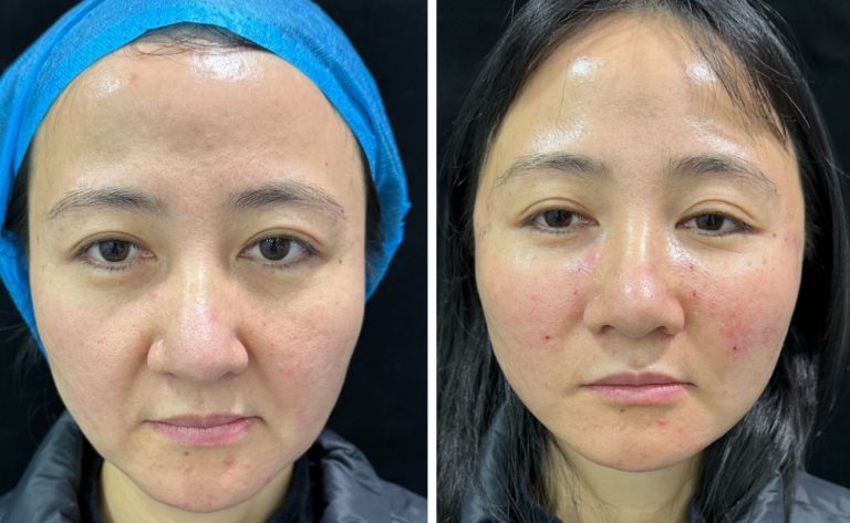 How to Fix Puckering After Thread Lift - Yastrid Medical Aesthetic Supplier