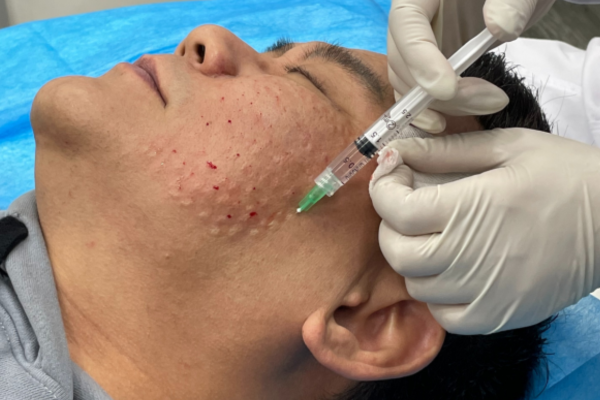 How Much Does a Meso Thread Face Lift Cost?