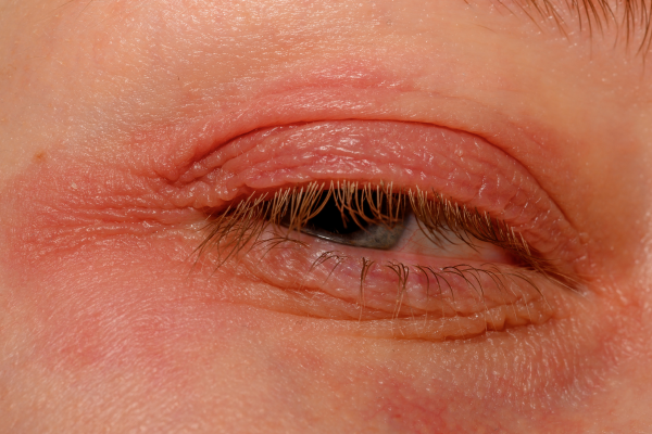 How to Fix PDO Threads Under Eyes Bruising - Yastrid Medical Aesthetic ...