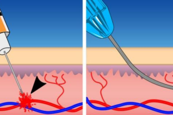 5 Tips For Choosing the Best Cannula for Filler Injection