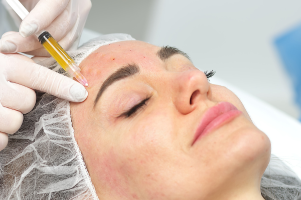 What is Vampire Facial: All You Need To Know