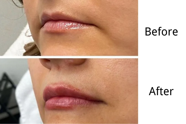 What to Expect The First Day After Lip Injections - Yastrid Medical ...