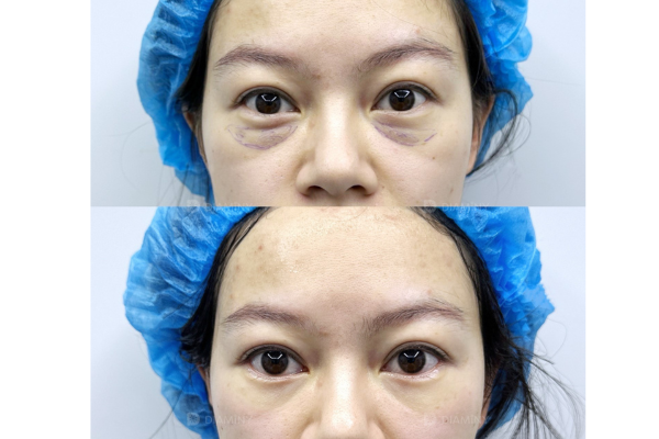 PDO Threads under Eyes Before and After Results - Yastrid Medical ...
