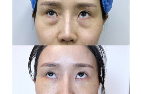 PDO Threads under Eyes Before and After Results - Yastrid Medical ...