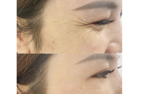 PDO Threads under Eyes Before and After Results - Yastrid Medical ...